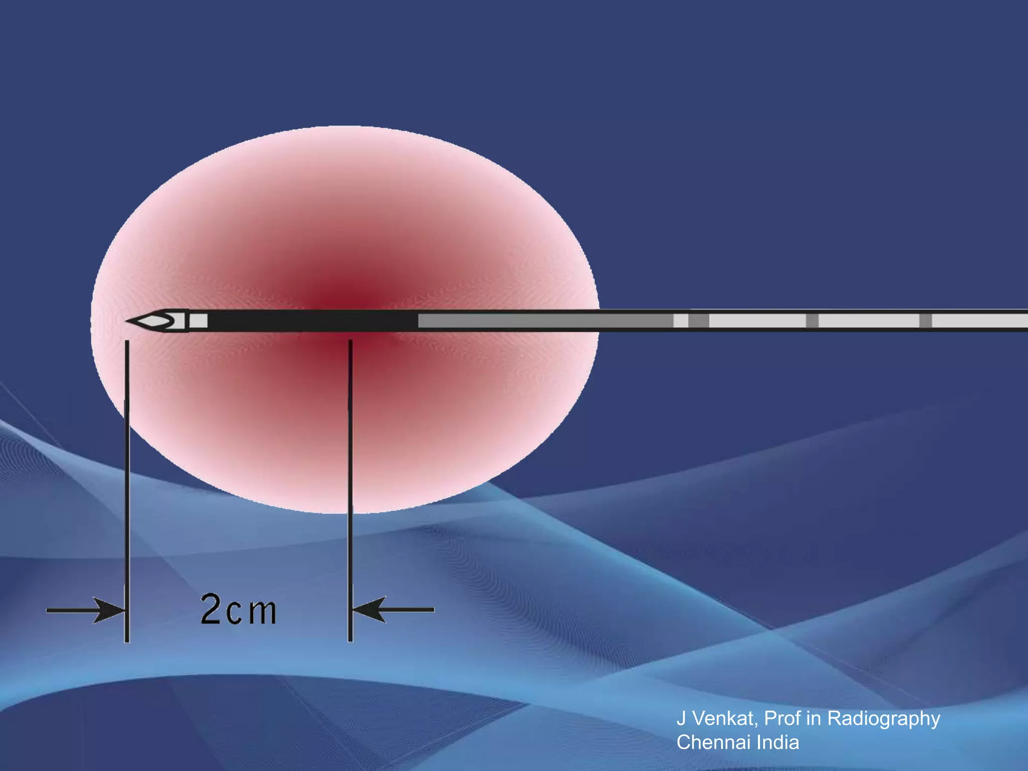 Microwave ablation by J Venkat may 2020 | PPT