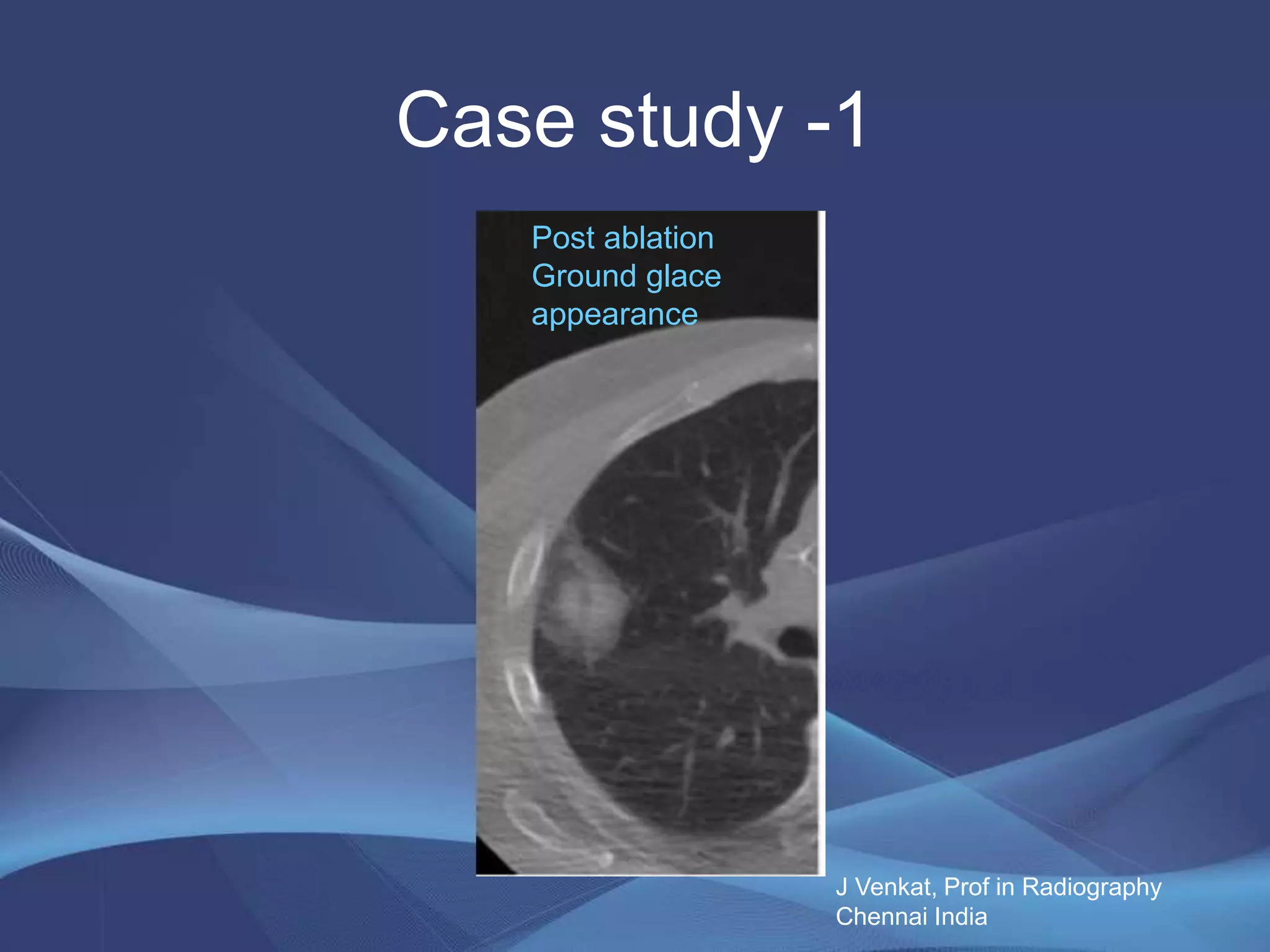 Microwave ablation by J Venkat may 2020 | PPT