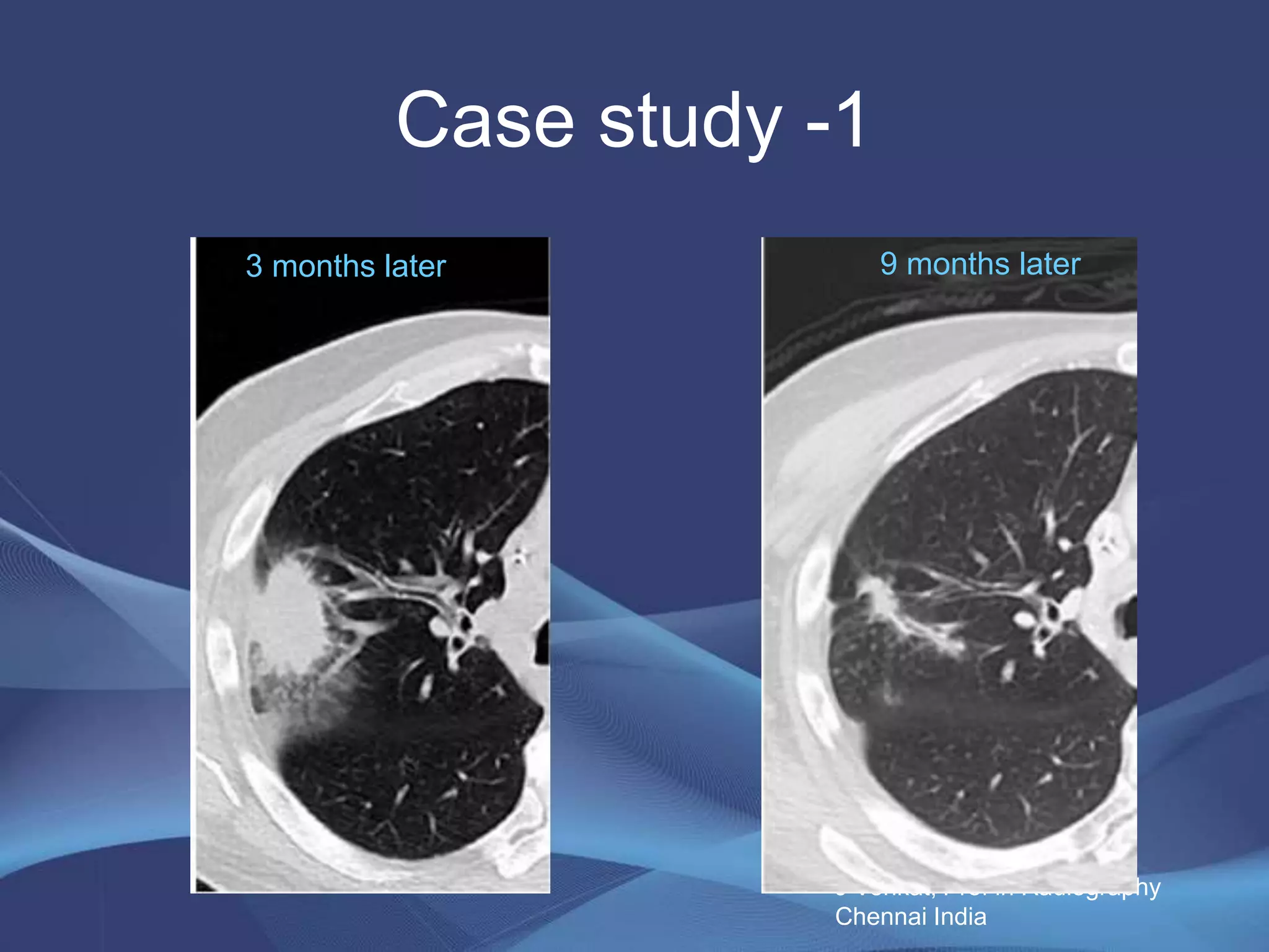 Microwave ablation by J Venkat may 2020 | PPT