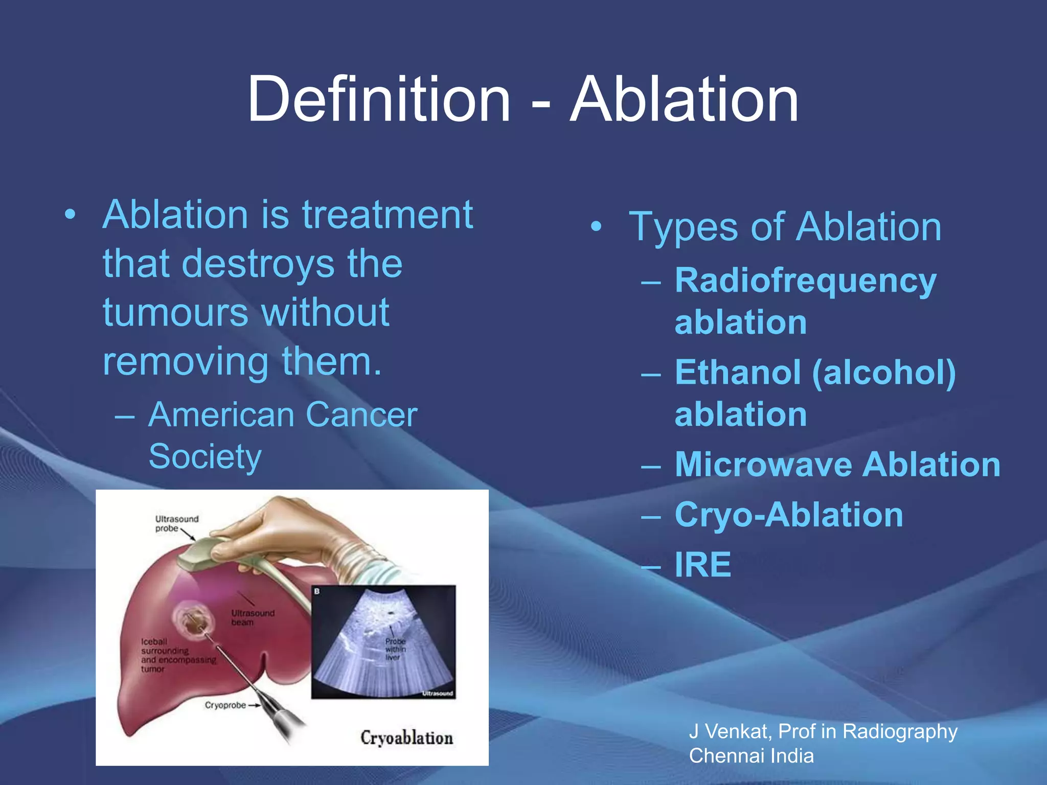 Microwave ablation by J Venkat may 2020 | PPT