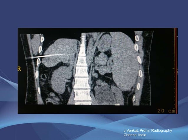 Microwave ablation by J Venkat may 2020 | PPT