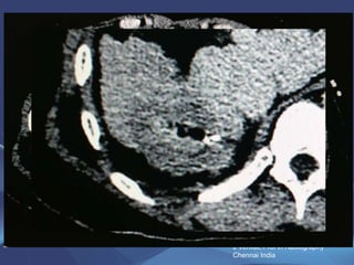 Microwave ablation by J Venkat may 2020 | PPT