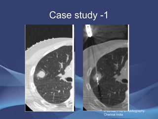 Microwave ablation by J Venkat may 2020 | PPT
