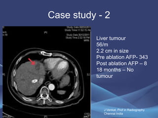 Microwave ablation by J Venkat may 2020 | PPT