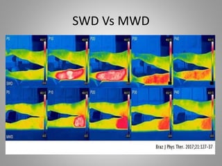 Microwave diathermy (MWD) for physiotherapists | PPTX