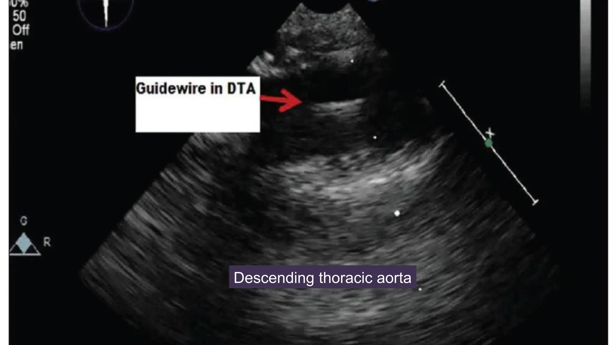 Minimal Invasive Cardiac Surgery Anesthesia Pptx 5957