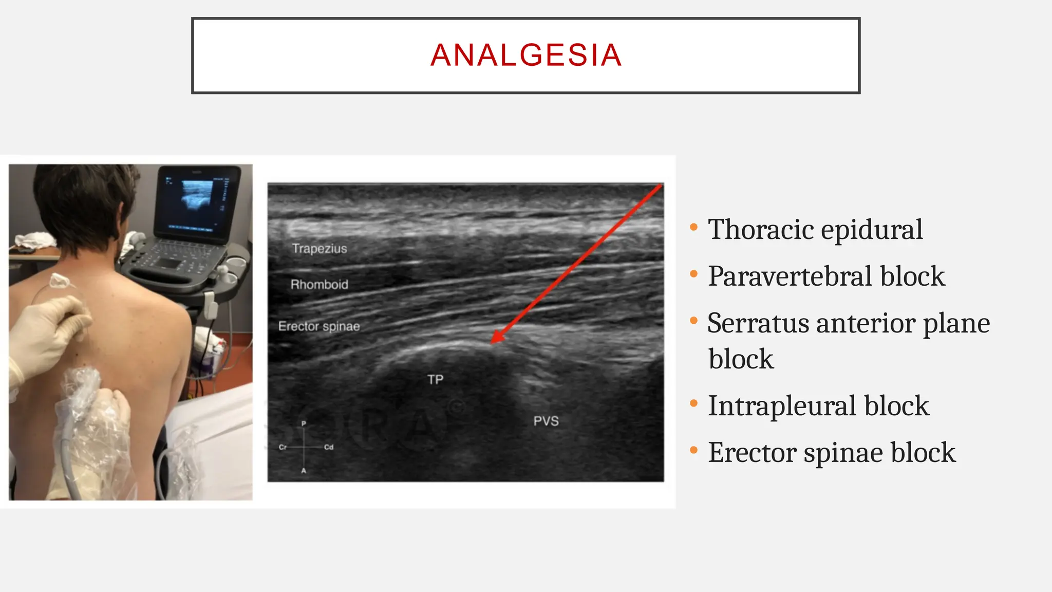 Minimal invasive cardiac surgery- Anesthesia | PPTX
