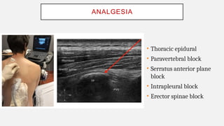 Minimal invasive cardiac surgery- Anesthesia | PPTX