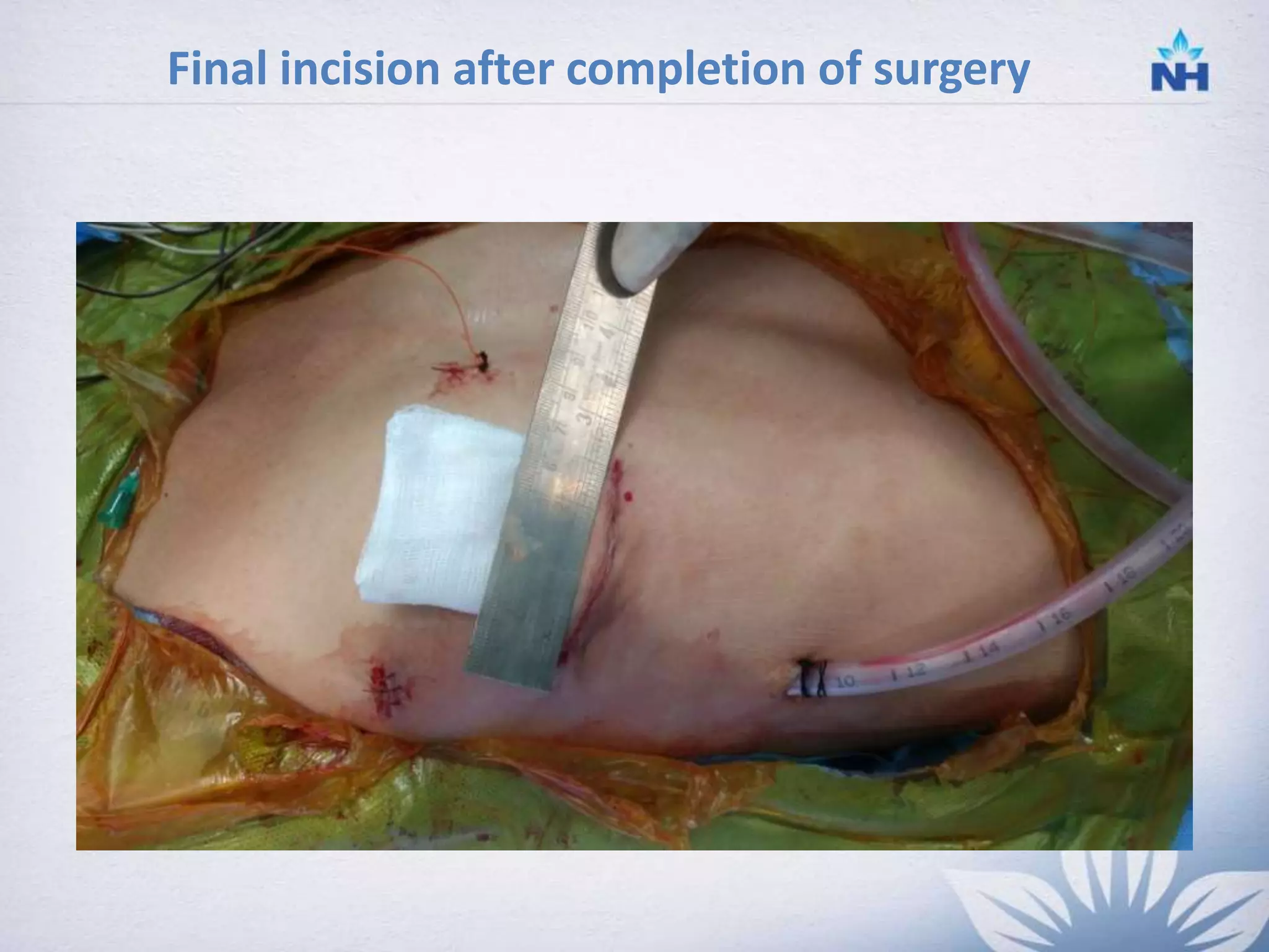Minimally invasive cardiac surgery | PPTX
