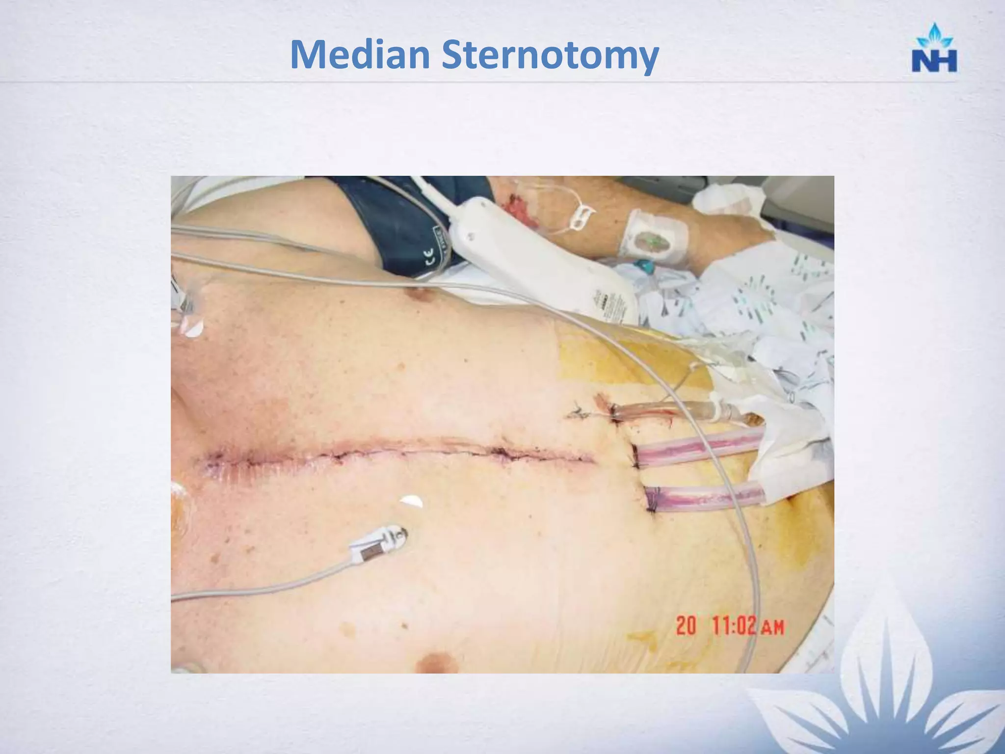 Minimally invasive cardiac surgery | PPTX