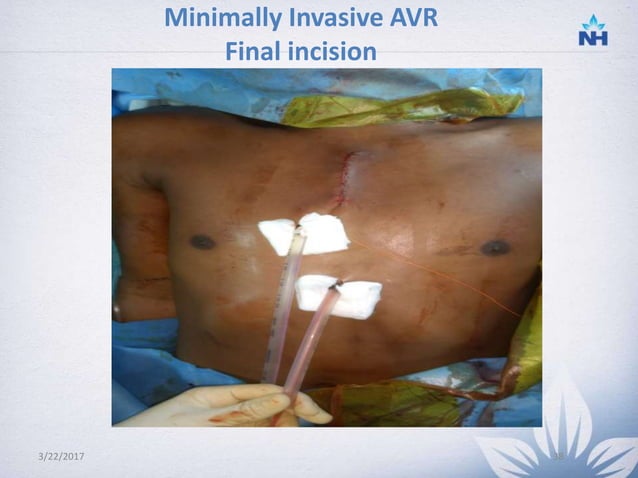 Minimally invasive cardiac surgery | PPTX | Heart and Cardiovascular ...