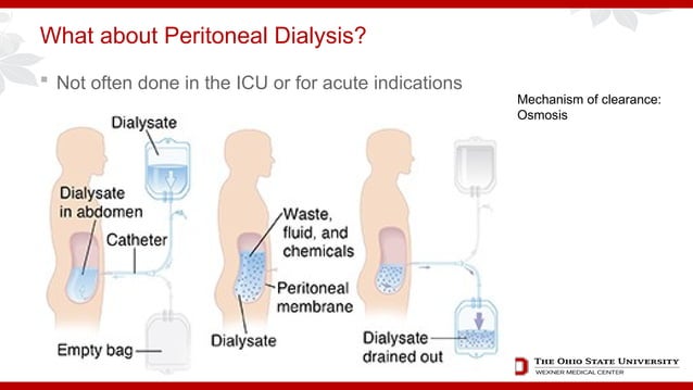Basics of Renal Replacement Therapy (RRT) | PPT