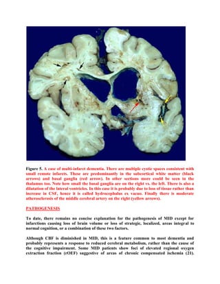 Topic of the month: Radiological pathology of multi-infarct dementia | PDF