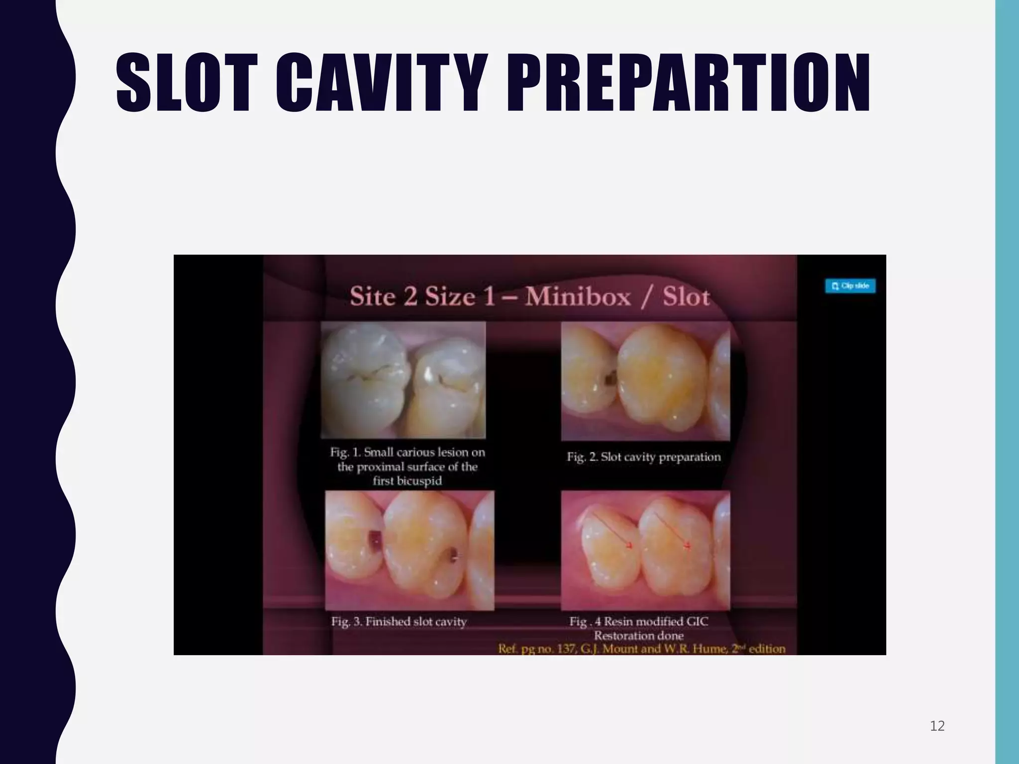 Minimally invasive dentistry | PPTX