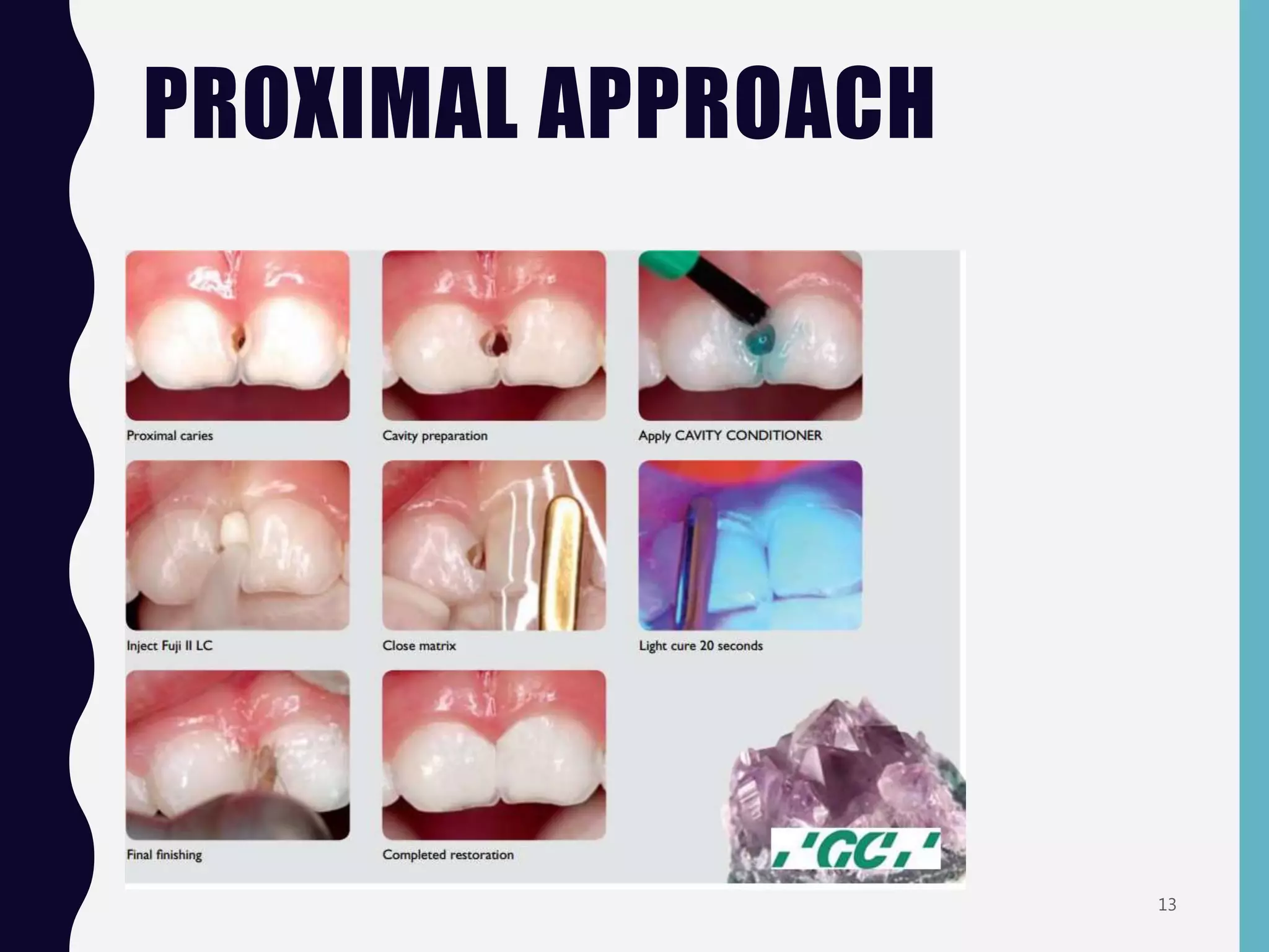 Minimally invasive dentistry | PPTX