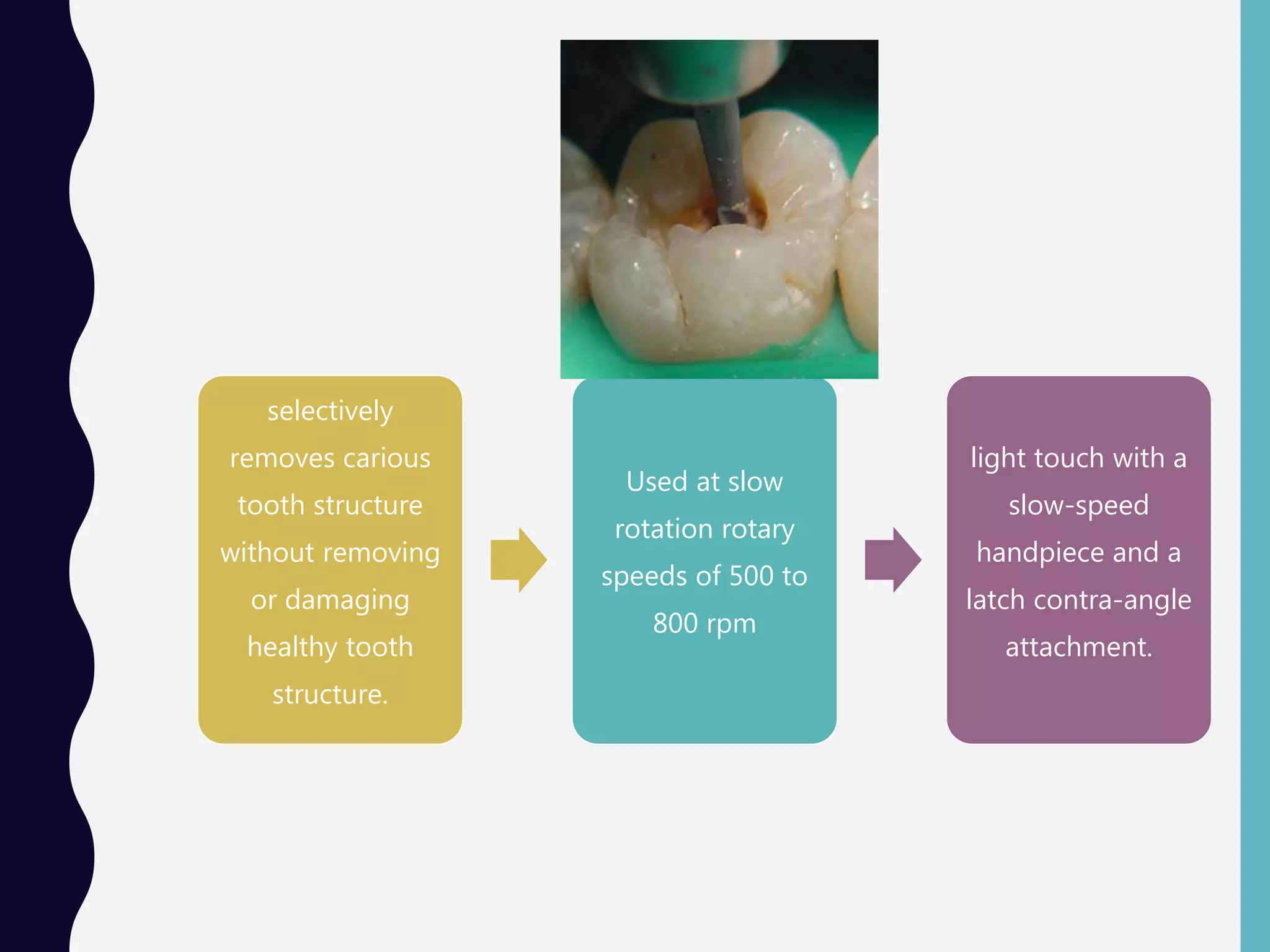 Minimally invasive dentistry | PPTX