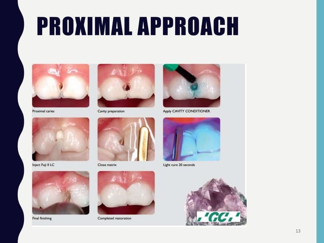 Minimally Invasive Dentistry Pptx 4023