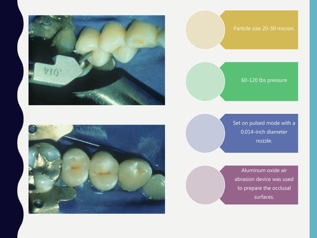 Minimally invasive dentistry | PPT