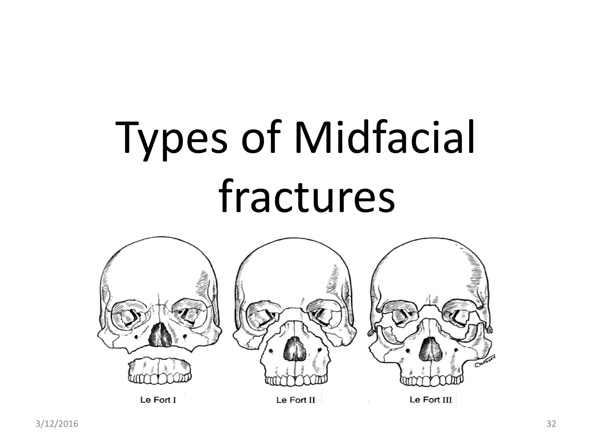 Mid facial fractures and their management | PPTX