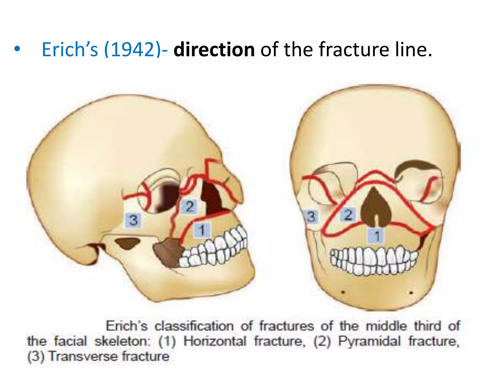 Mid facial fractures and their management | PPTX