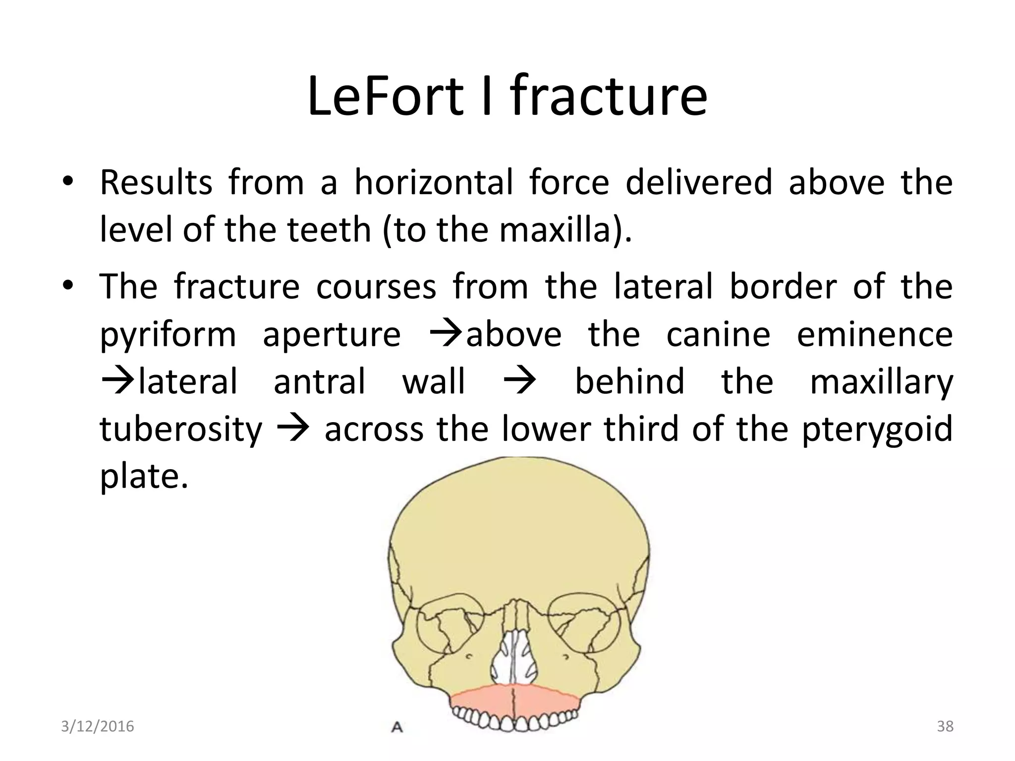 Mid facial fractures and their management | PPTX