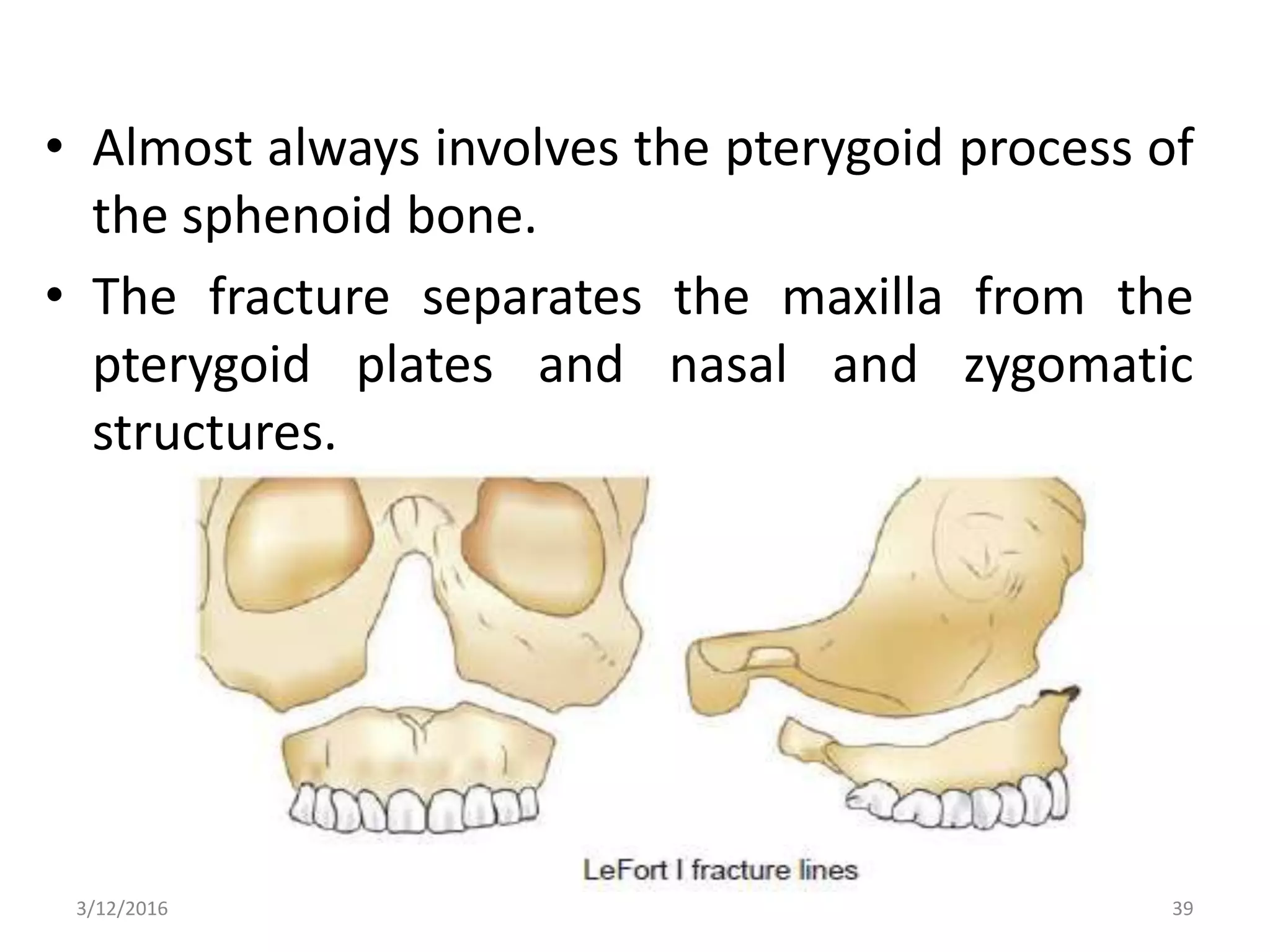 Mid facial fractures and their management | PPTX