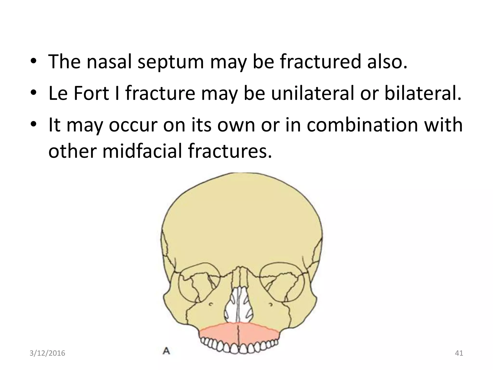 Mid facial fractures and their management | PPTX