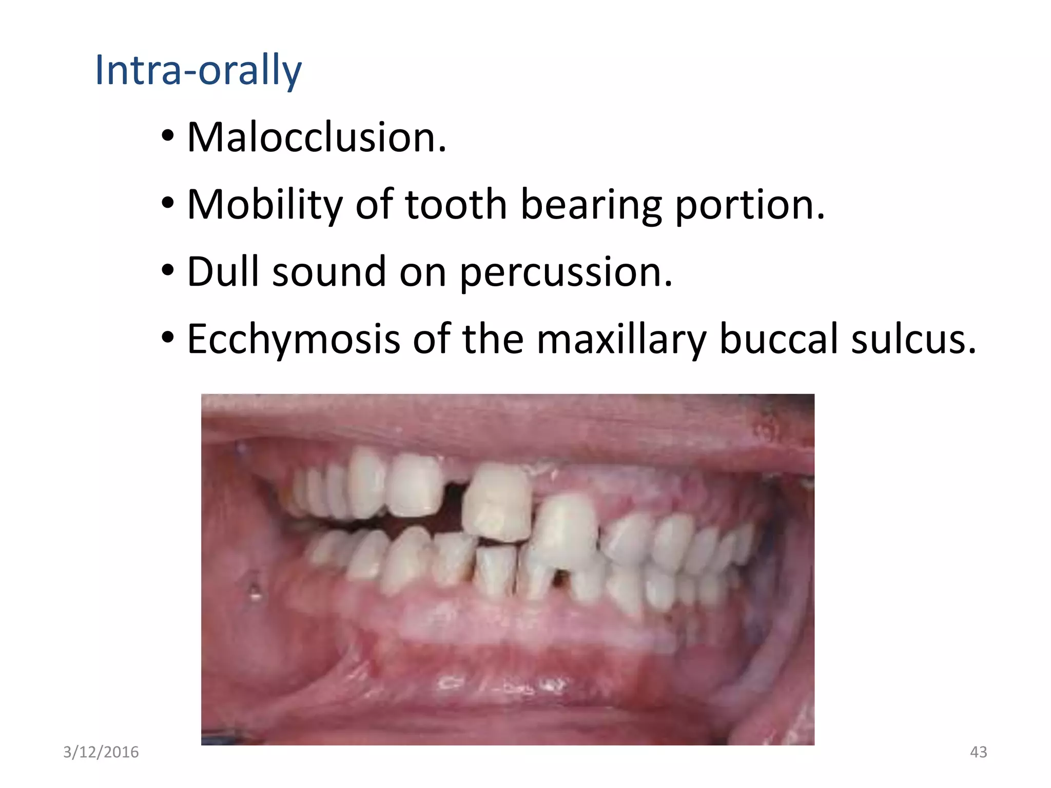 Mid facial fractures and their management | PPTX