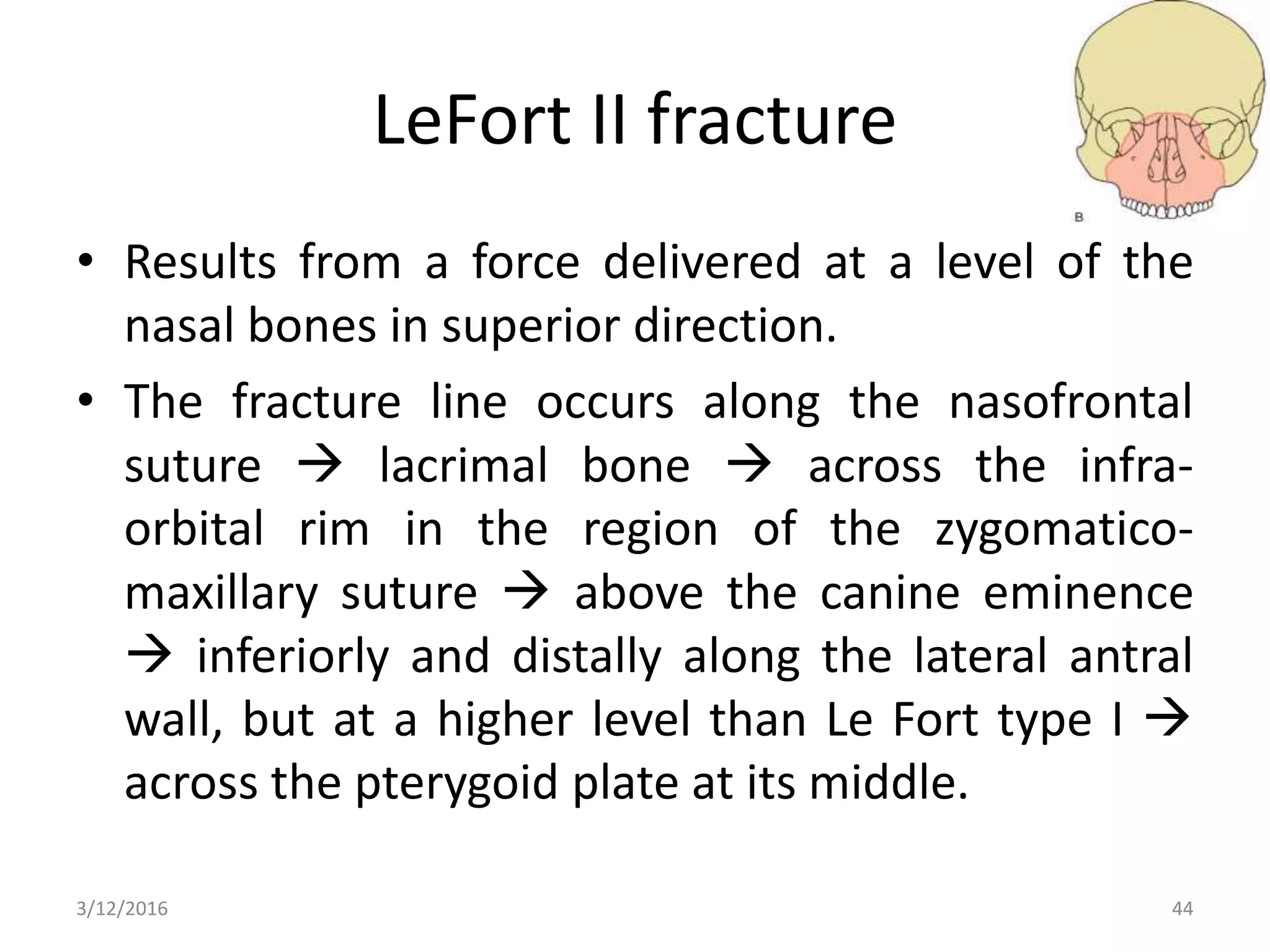 Mid facial fractures and their management | PPTX