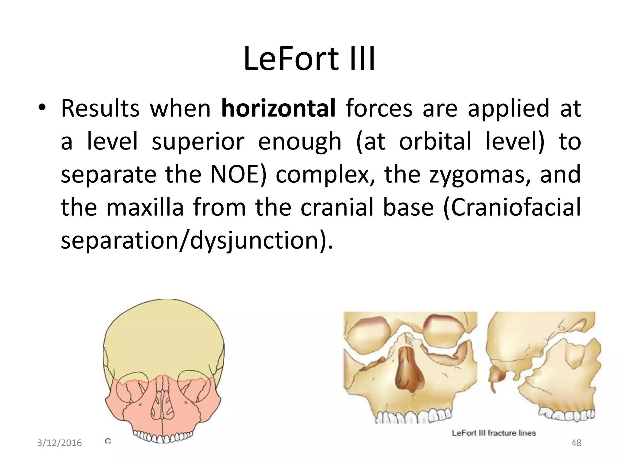 Mid facial fractures and their management | PPTX