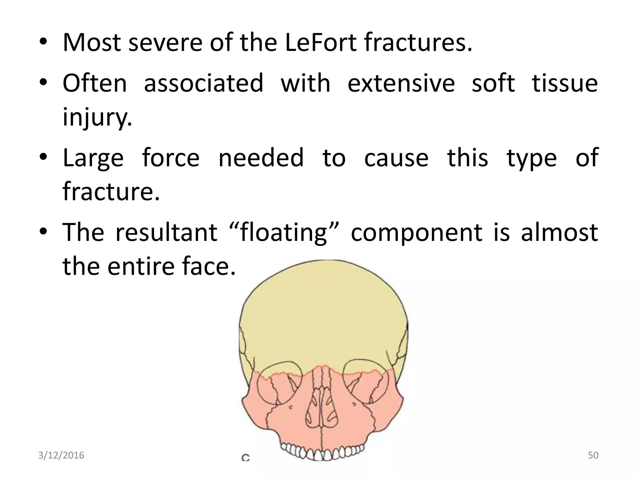 Mid facial fractures and their management | PPTX