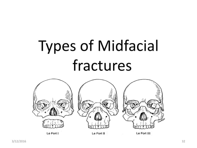Mid facial fractures and their management | PPTX