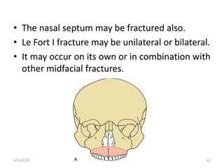 Mid facial fractures and their management | PPTX