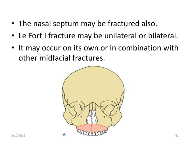Mid facial fractures and their management | PPTX