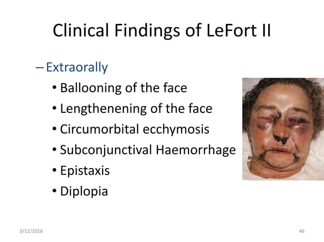 Mid facial fractures and their management | PPTX