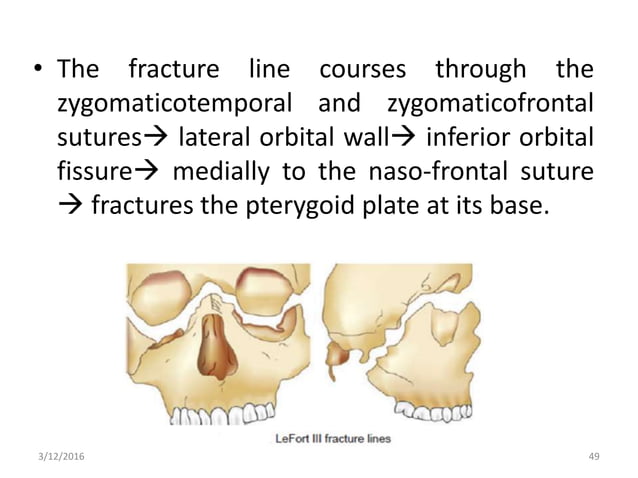 Mid facial fractures and their management | PPTX