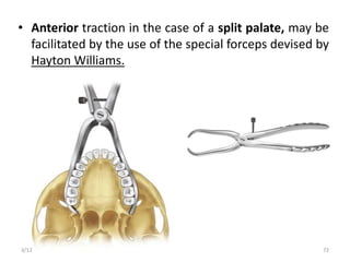 Mid facial fractures and their management | PPTX