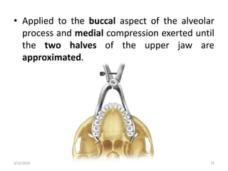 Mid facial fractures and their management | PPTX