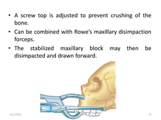 Mid facial fractures and their management | PPTX
