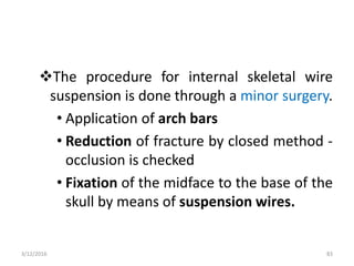 Mid facial fractures and their management | PPTX
