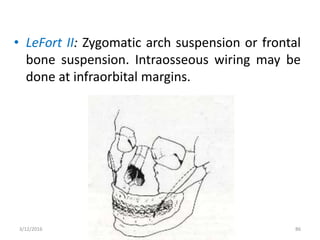 Mid facial fractures and their management | PPTX