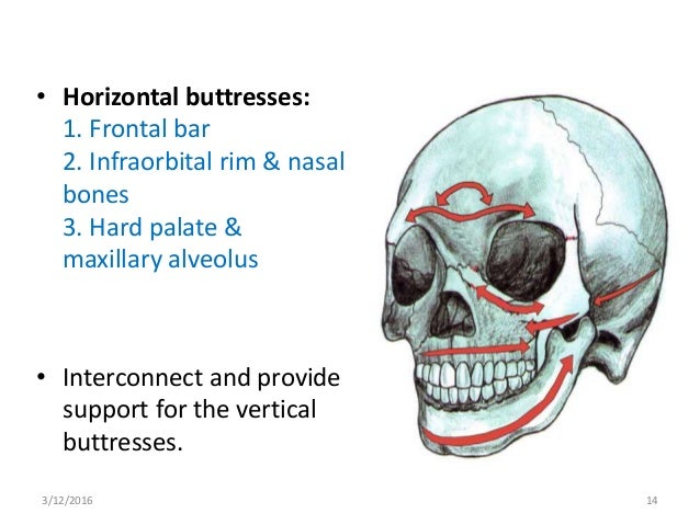 Mid facial fractures and their management