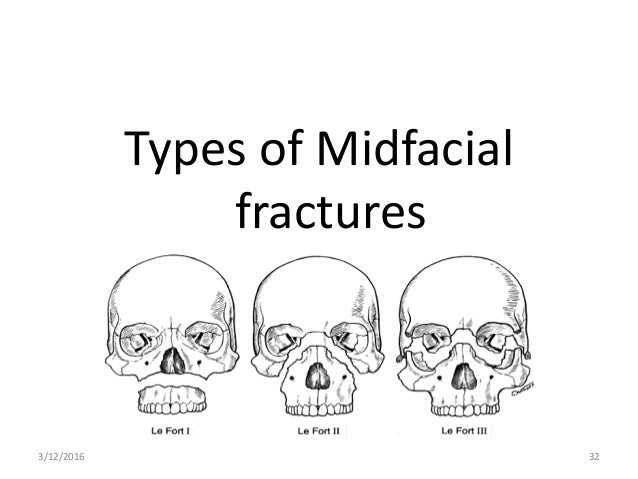 Mid facial fractures and their management