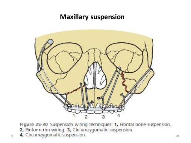 Mid facial fractures and their management