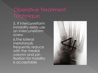 Mid foot lisfranc fracture | PPTX