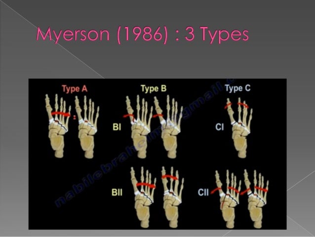 Mid foot lisfranc fracture