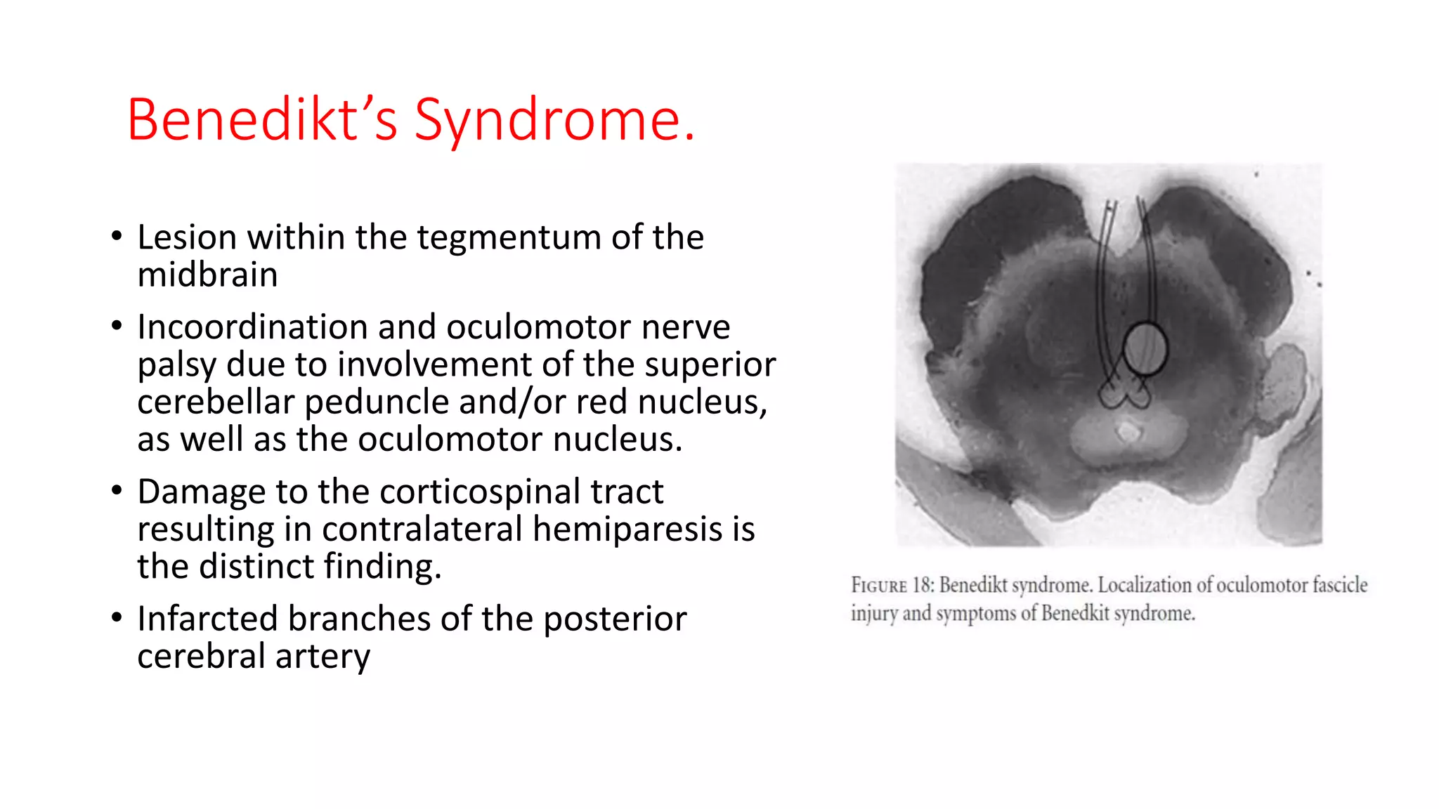 Mid brain anatomy and vascular syndromes | PPTX