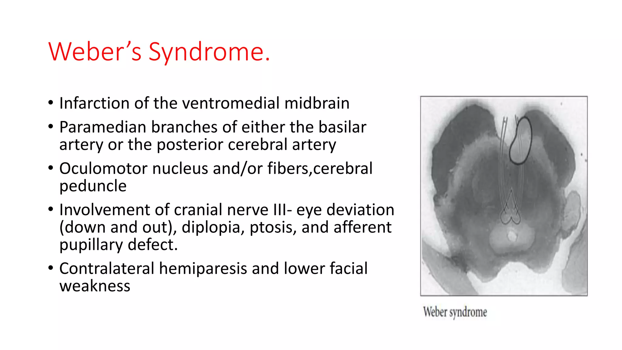Mid brain anatomy and vascular syndromes | PPTX