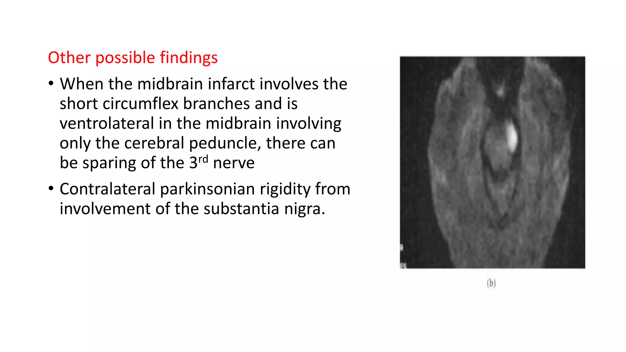 Mid brain anatomy and vascular syndromes | PPTX