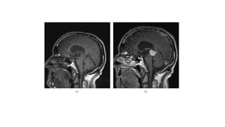 Mid brain anatomy and vascular syndromes | PPTX